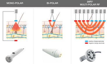 Venus Concept® MP2 technologie met Multipolaire RadioFrequentie